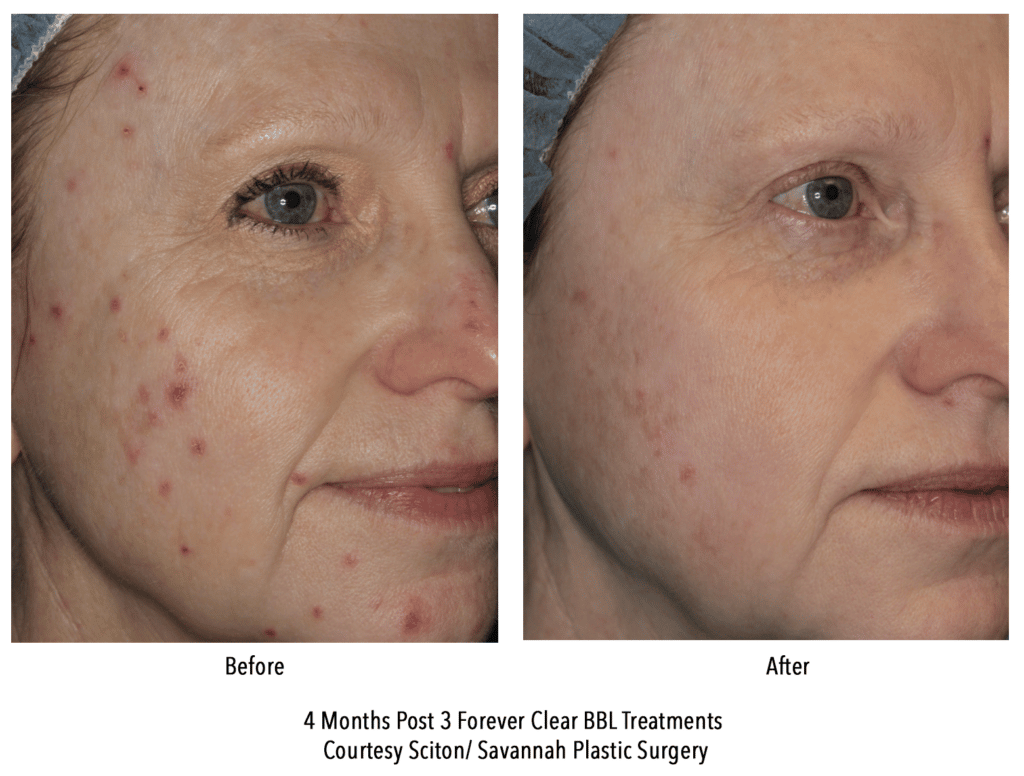 What Is BBL? - Jeffrey Dawes MD