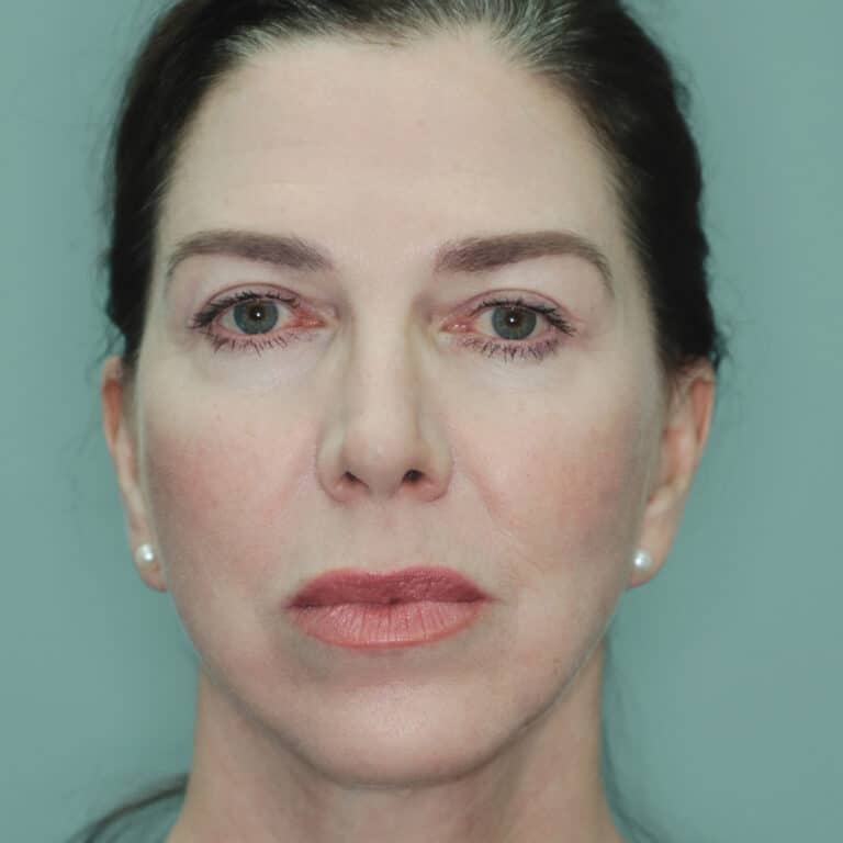 Face Surgery Before and After Gallery - Calgary