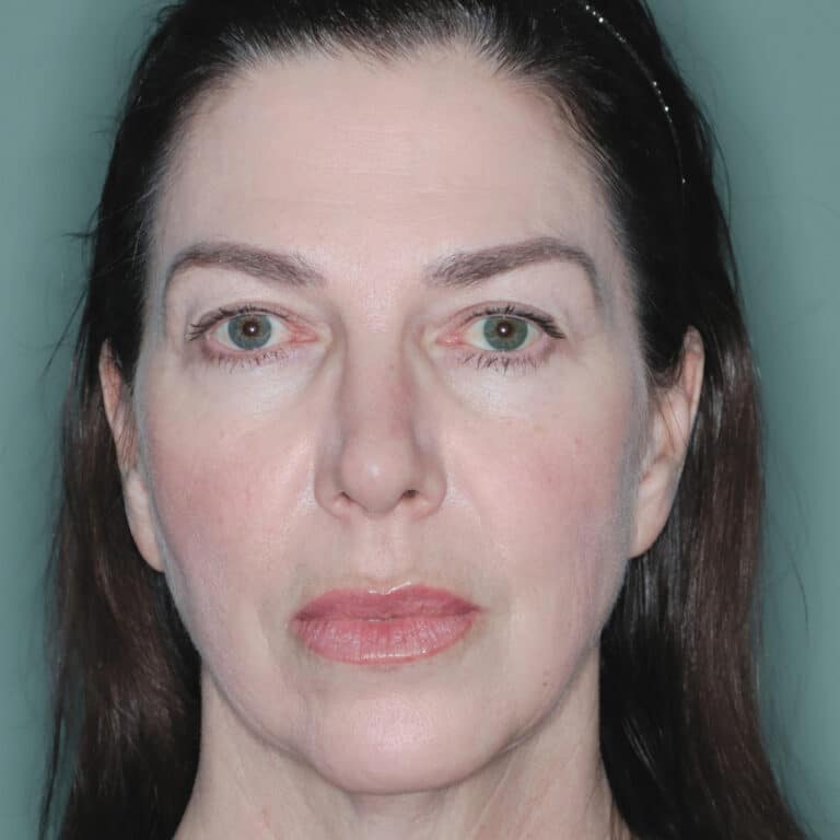 Face Surgery Before and After Gallery - Calgary